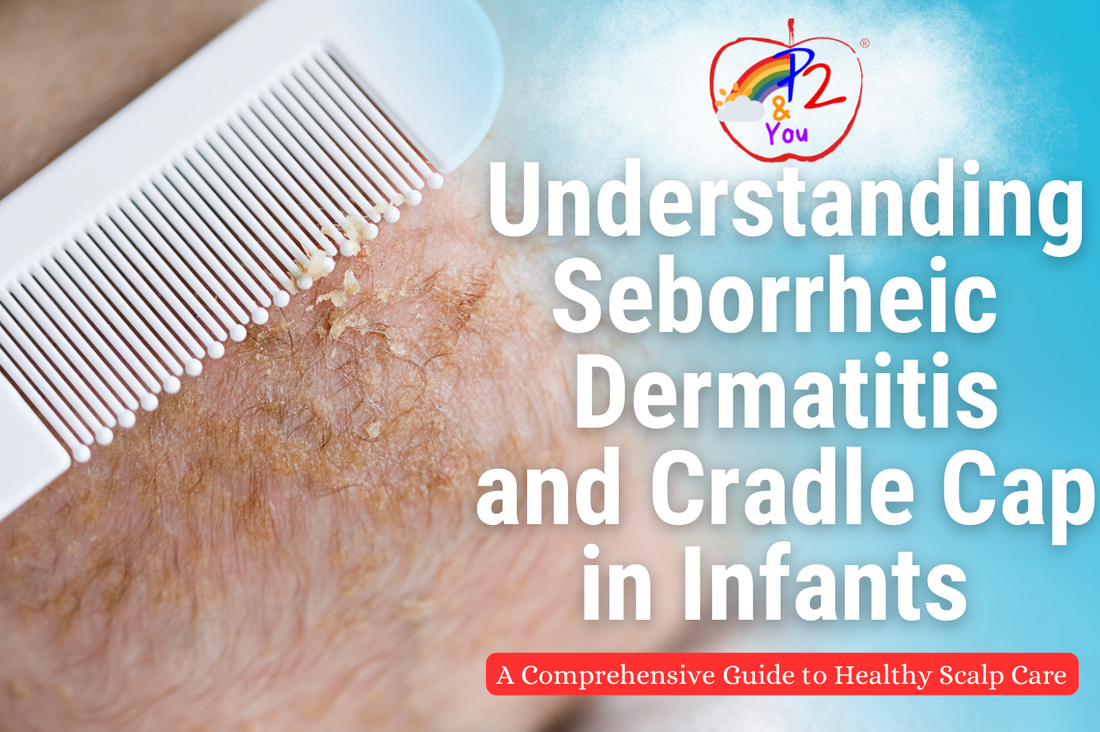 Understanding Seborrheic Dermatitis and Cradle Cap in Infants – P2 & You